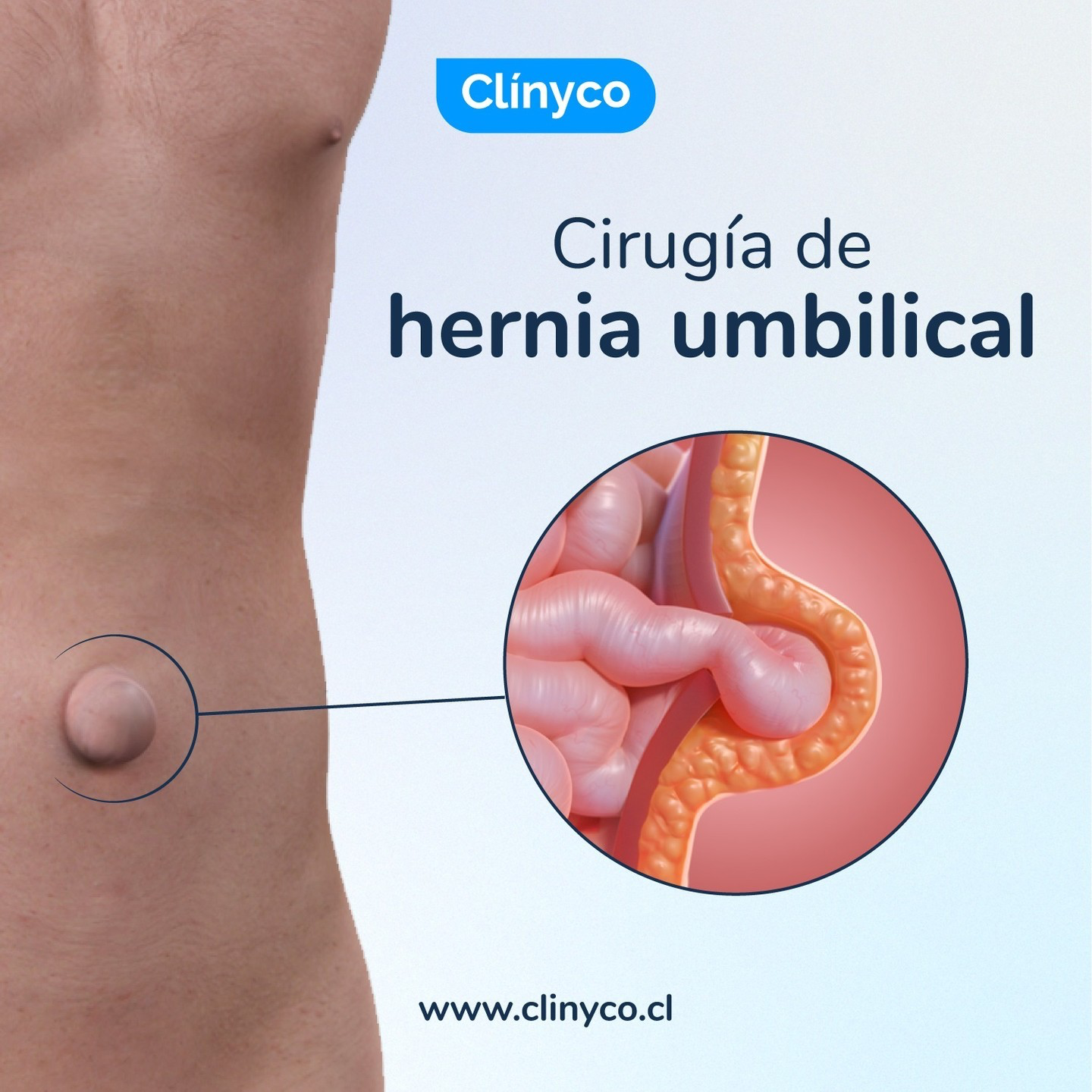 Hernia en el ombligo: ¿cuándo es necesario el tratamiento? - Clinyco