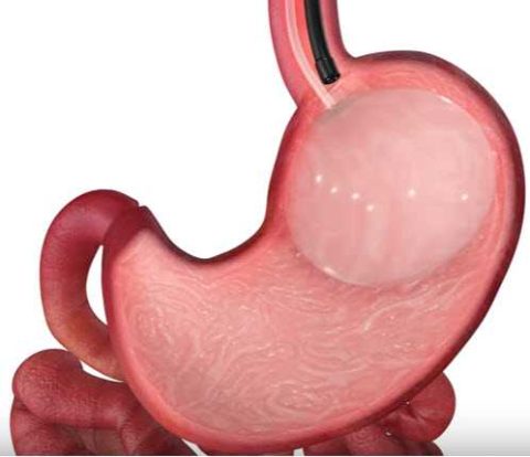 Balón intragástrico: ¿qué es y cómo ayuda a combatir la obesidad? - Clinyco